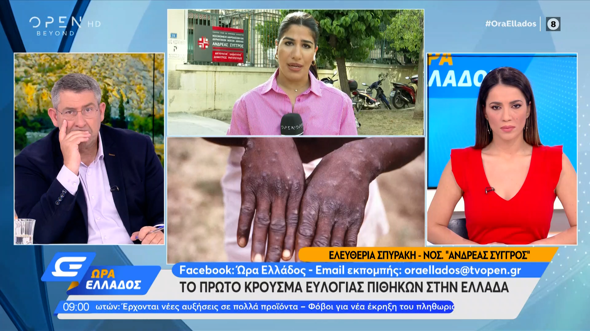 Το πρώτο κρούσμα ευλογιάς των πιθήκων στην Ελλάδα | OPEN TV