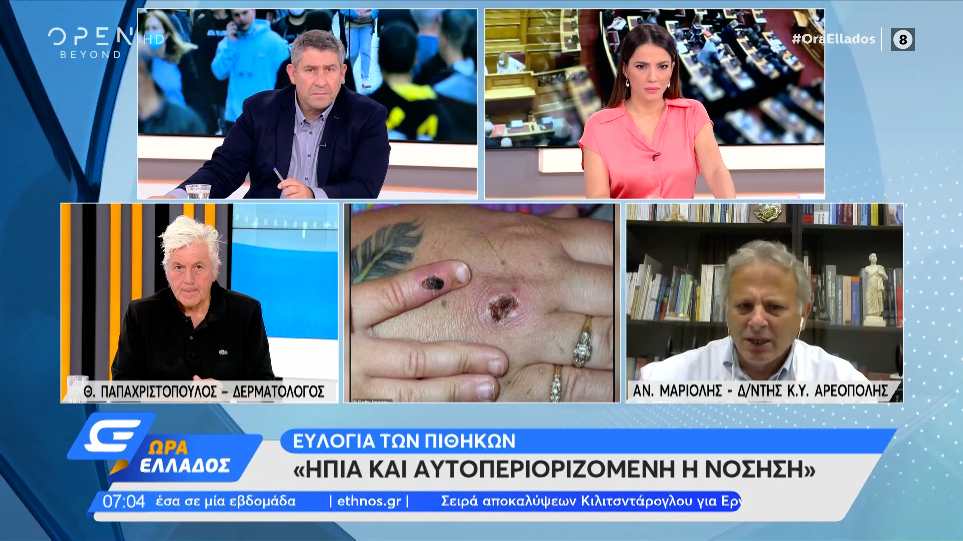 Ο Ανάργυρος Μαριόλης για την ευλογιά των πιθήκων | OPEN TV